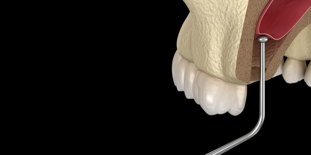 Dr. Darryl A. Field | Sinus Lift (Sinus Augmentation)